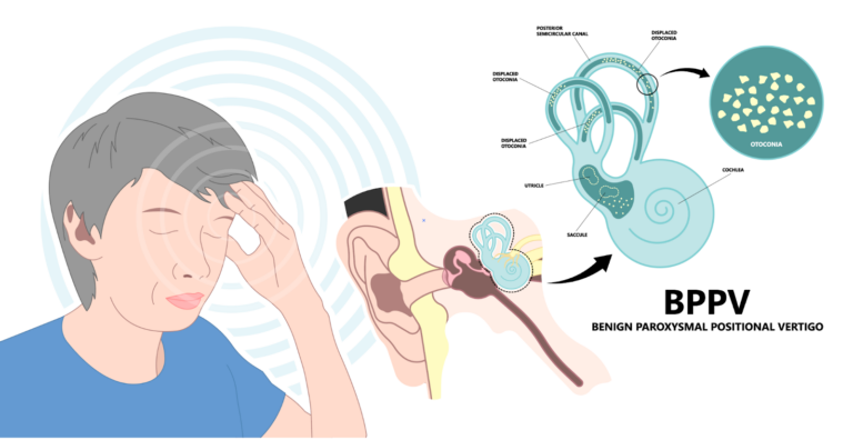 BPPV (Benign Paroxysmal Positional Vertigo) Demystified: Diagnosis and ...